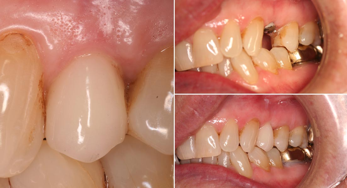 Dental Implants in Silver City | Sherman Dental