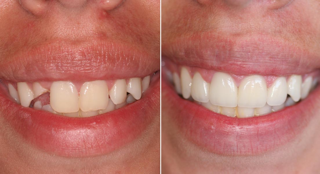 Veneers | Silver City Dentist
